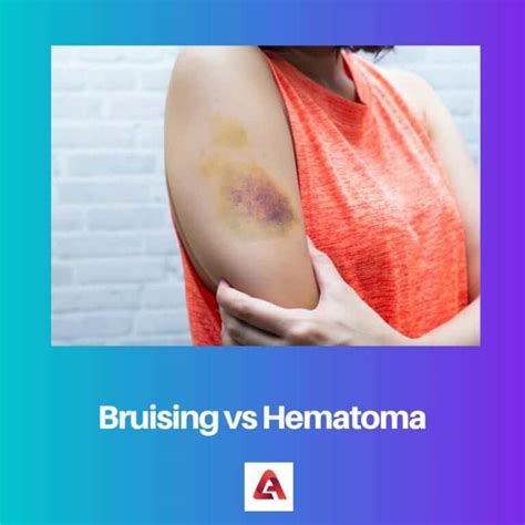 Bruising Vs Hematoma Difference And Comparison