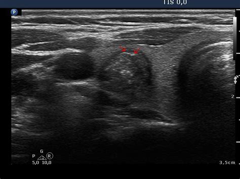 Selected Topics Intranodular Hyperechogenic Figures