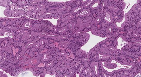 Non Intestinal Type Sinonasal Adenocarcinoma Ottawa Atlas Of Pathology