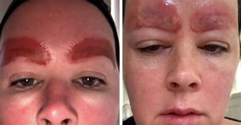 Woman Gets Terrible Infection After Microblading Her Eyebrows