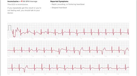 Pvc Trigeminy Rreadmyecg