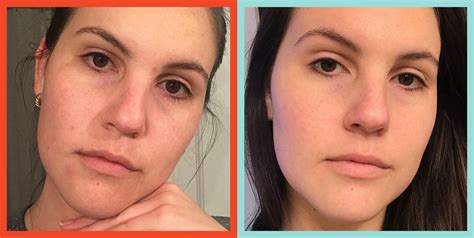 Skin Type Quiz Curology At Arthur Popp Blog