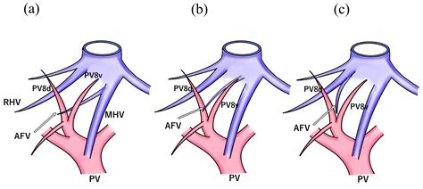 Hepatic Vein Guided Approach In Laparoscopic Anatomic Liver Resection Of The Ventral And Dorsal