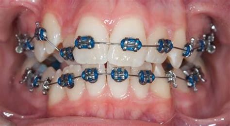 ბრეკეტი Braces