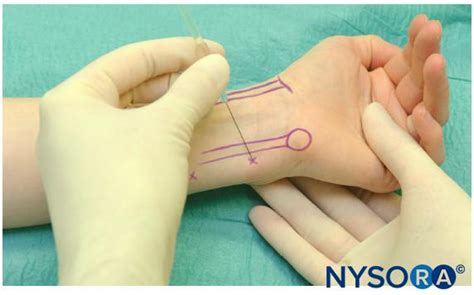 Wrist Block Landmarks And Nerve Stimulator Technique Nysora