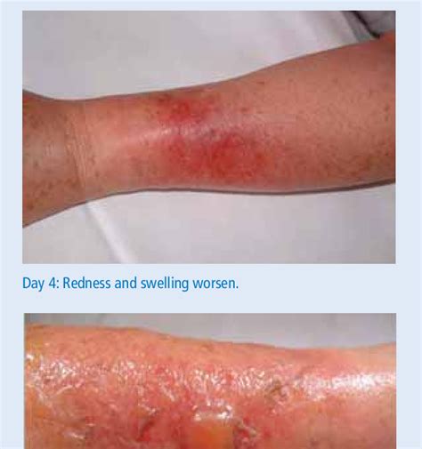 Doxorubicin Extravasation