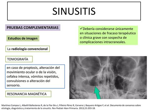 Rinitis Adenoiditis Sinusitis Croup Pptx