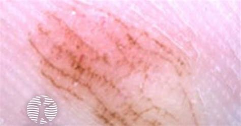 Acral Naevus Dermoscopy Image