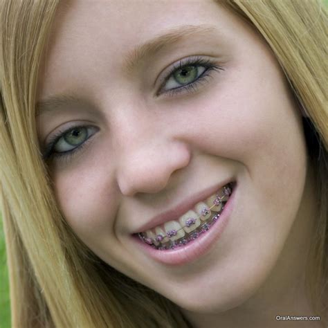 Braces Oral Answers