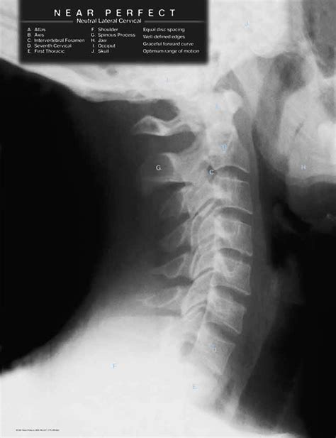 Normal Cervical Curve