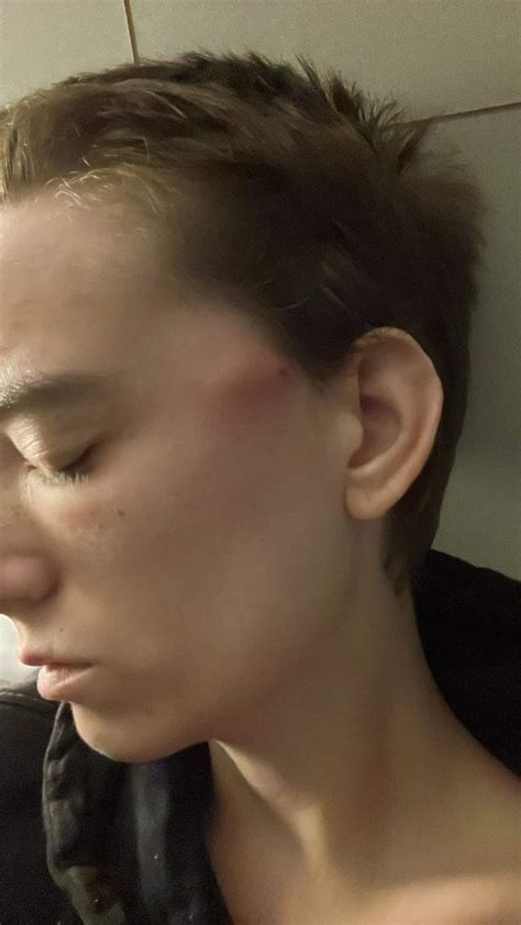 Possible Spider Bite About 3 Days Ago Spread And Whole Right Side Of Face Is Swollen Any