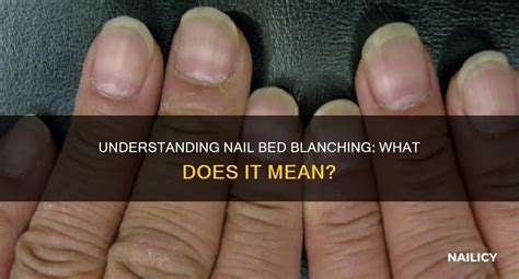 Understanding Nail Bed Blanching What Does It Mean Nailicy