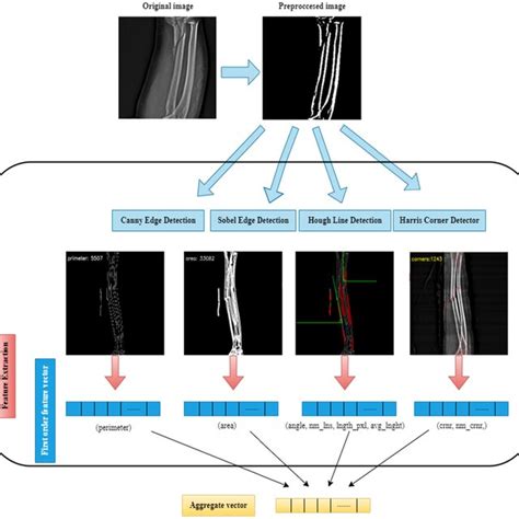 Image Processing And Machine Learning‐based Bone Fracture Detection And