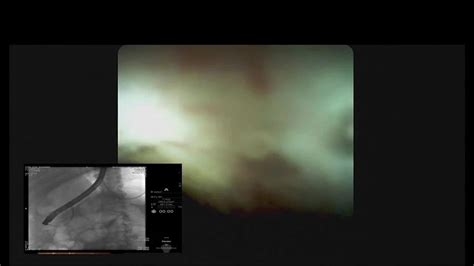 Catherine F On Linkedin Second Opinion Mirizzi Syndrome Results In