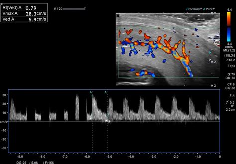 Doppler Ultrasound Image Of The Cavernosal Artery And Velocity Download Scientific Diagram