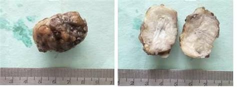 2 Gross Features Nodular Structure Covered By Yellowish Fat Cut Download Scientific