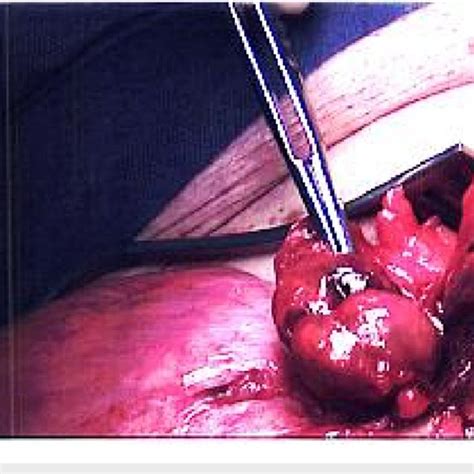 Operative Findings The Forceps Showing The Inflamed Epiploic Appendage Download Scientific