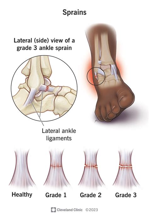 Ankle Sprain On Inside Of Foot Factory Sale