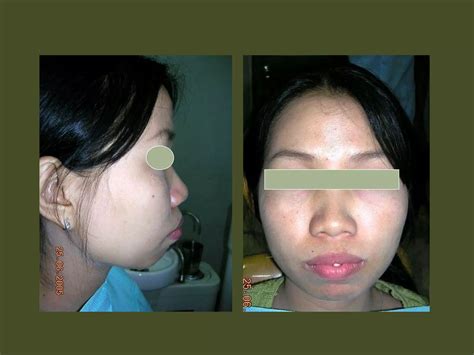 Class Ii Malocclusion Ppt