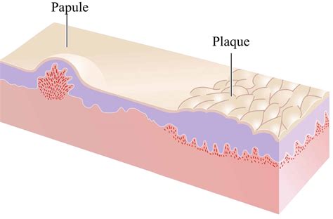 Macule Vs Papule