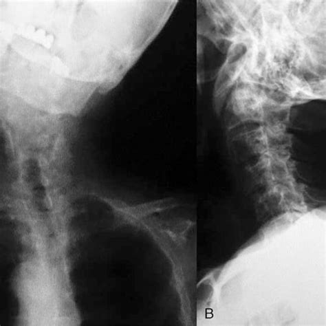 Ao Classification C Rotation C1 Unilateral Facet Download