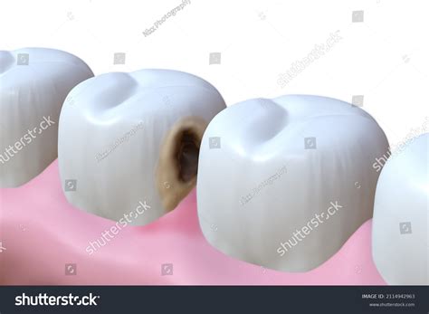 카리 충치 및 건강한 치아로 사람 스톡 일러스트 2114942963 Shutterstock