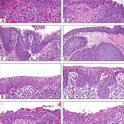 Pdf P16 And Ki 67 Immunostaining In Atypical Immature Squamous Metaplasia Of The Uterine