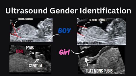 Ultrasound Gender Identification How To Identify 14 Weeks To Second