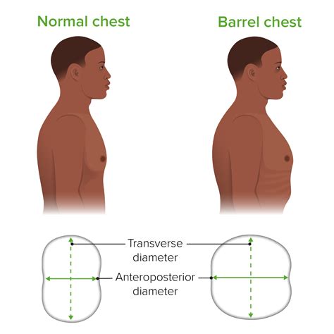 Barrel Chest Copd Emphysema