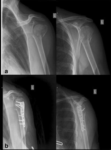 A Valgus Impacted 3 Part Fracture Of A Left Shoulder Treated Using The