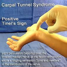 Tinels Sign Carpal Tunnel Tens Unit Placement Hand Nerves Carpal