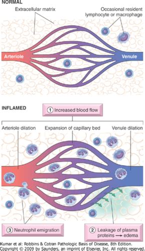 Pathology Lecture 4 Inflammation Part 1 Flashcards Quizlet