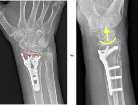 I Have A Broken Wrist A Primer On Distal Radius Fracture Surgery — Dr Nick Golinvaux