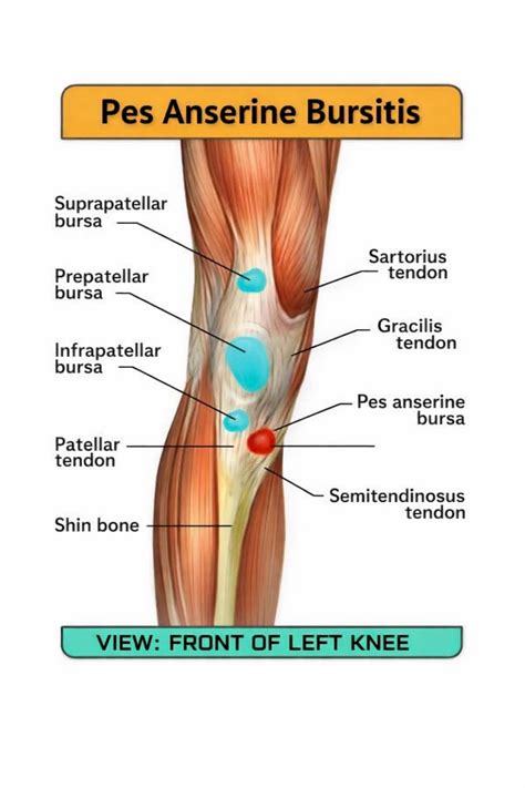 Pes Anserine Bursitis Artofit