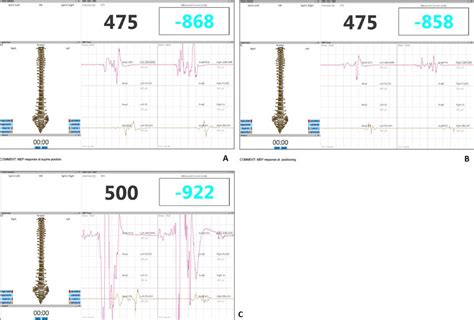 Figure Showing The Transcranial Electric Stimulation Motor Evoked Download Scientific Diagram