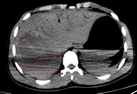 Type Iv Cyst 7 93x11 64 Cm In Liver Segment 7 Download Scientific Diagram