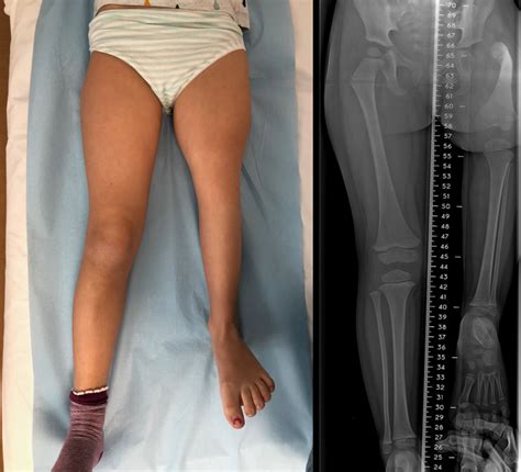 Hypoplasie Inégalité Et Malformation Membres Inférieurs