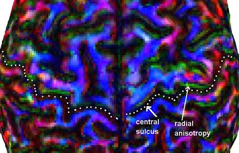 Top View On The Brain With Color Coded Fa Values The Green Stripe Download Scientific Diagram