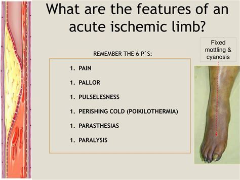 Ppt Peripheral Vascular Disease Acute And Chronic Limb Ischemia