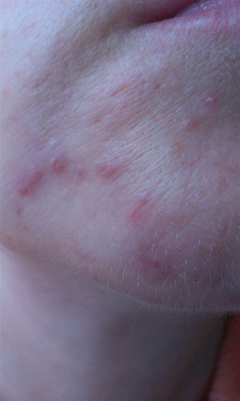 Прыщи на подбородке Вопрос косметологу 03 Онлайн