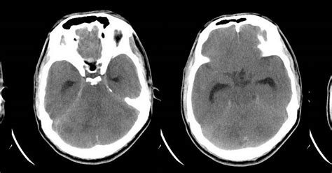 Neuroradiology Cases Subdural Empyema