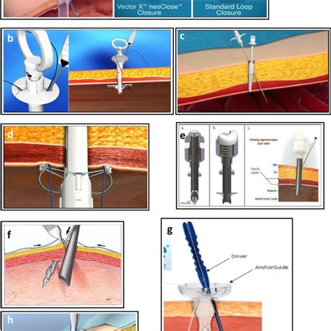 Representative Selection Of Laparoscopic Instruments And Closure Techniques Download