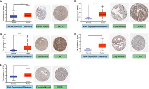 Pan Cancer Analysis Of The Prognostic And Immunological Role Of Nucleophosmin Nucleoplasmin 3