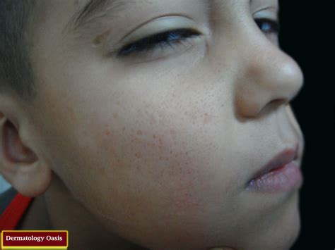 Atrophoderma Vermiculatum Dermatology Oasis