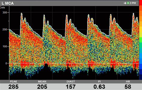 Vasospasm And Sah With Tcd Viasonix