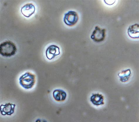 Different Types Of Dysmorphic Erythrocytes Phase Contrast Microscopy Original Magnification