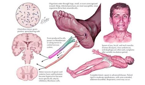 Tetanus Medizzy