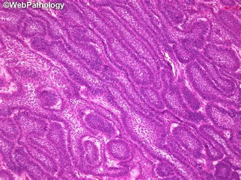 Ameloblastoma Basaloid Pattern