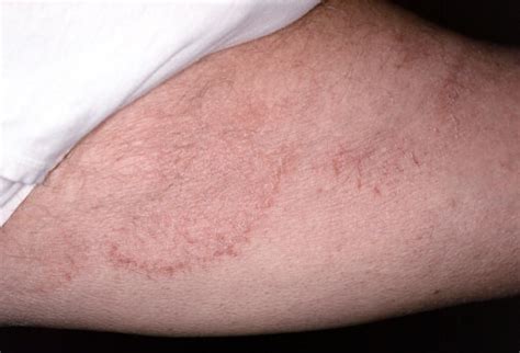 Healthy Life Ringworm Tinea