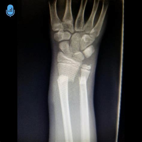 Orthobullets Both Bone Forearm Fractures Are One Of The